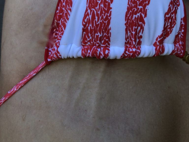 Mondor-szalagok a mell plasztikai műtétje után | Savage Rose